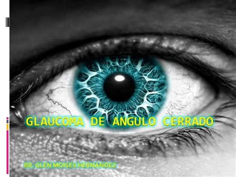 Glaucoma De Angulo Cerrado By Dr Glen Hernandez Ppt