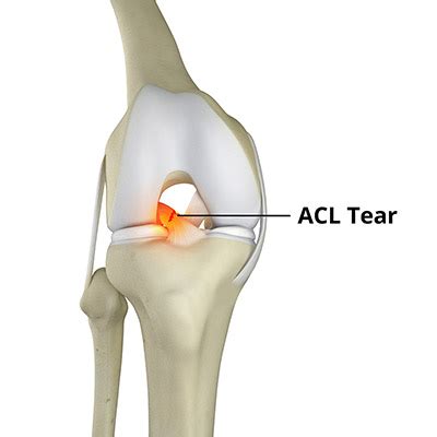 ACL Tears Surgeon Chandler AZ Casa Grande Hip Fracture Mesa Queen