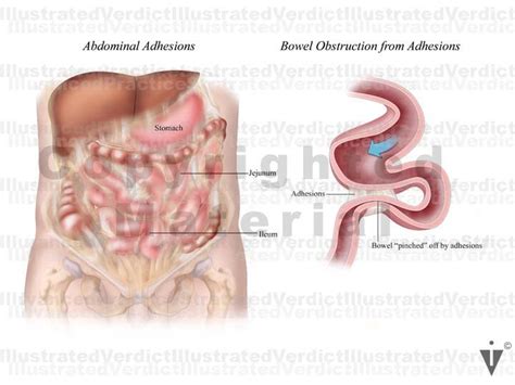 Stock Bowel Anomalies Obstructions Injuries Illustrated Verdict