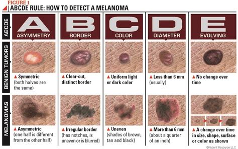 Melanoma Follow Up