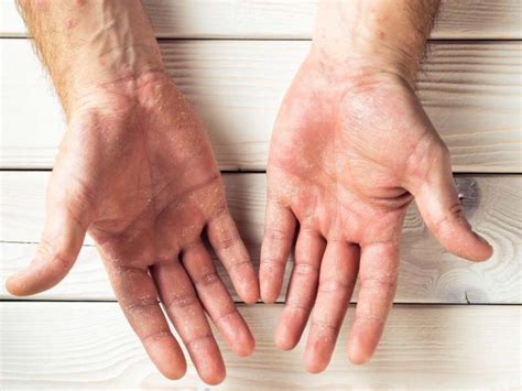 Psoriasis Vs Eczema How To Tell Them Apart Remotederm
