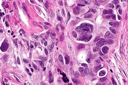 Serous Carcinoma Of The Ovary Libre Pathology