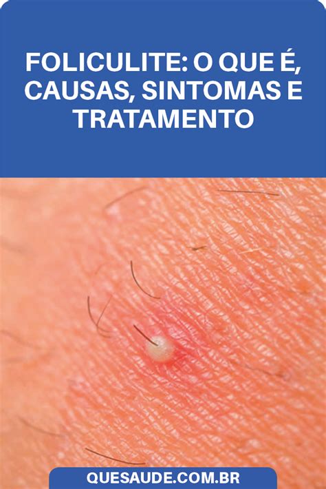 Pin on Doenças