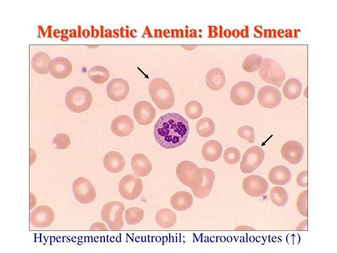 PPT The Megaloblastic Anemias Vitamin B 12 Folate Deficiency