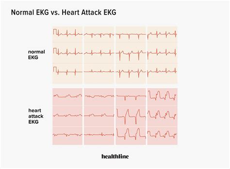 Does An Ekg Show An Irregular Heartbeat Printable Templates Protal