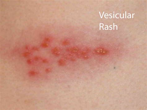Vesicular Rash Shingles