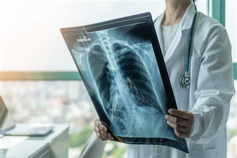 Edema Pulmonar O Que Causas E Tratamentos Dicas De Muscula O Hot Sex