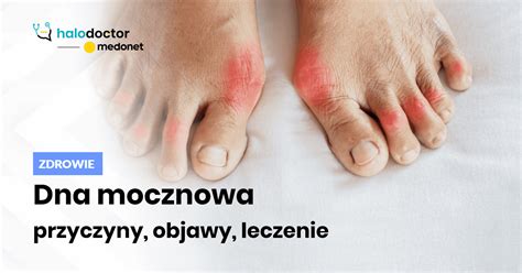 Dna Moczanowa Objawy Przyczyny Leczenie Diagnostyka Choroby The Best