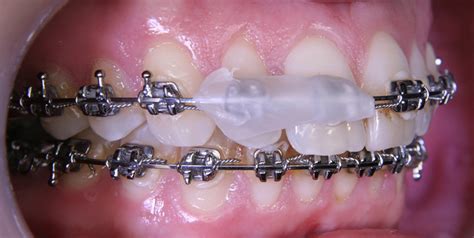 Do Braces Hurt Orthoactive Orthoactive