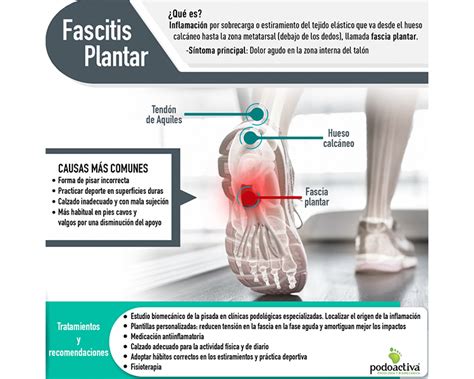 Fascitis Plantar Causas S Ntomas Y Tratamiento Efectivo