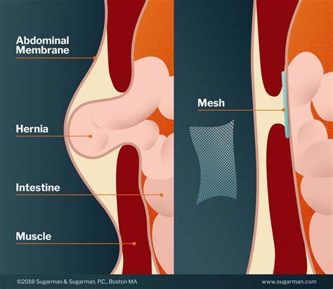 Hernia Mesh Failures And Injuries Sugarman