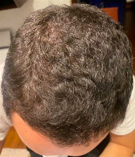 Tratamientos para Alopecia Soy Radiante Dermatología Bogotá