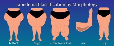 Lipedema Qu Es S Ntomas Y Tratamiento