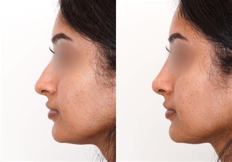 Non Surgical Nose Job Ubicaciondepersonas Cdmx Gob Mx