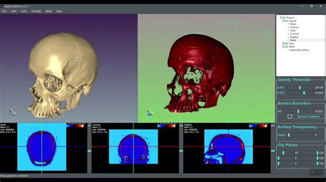 DICOM Images To 3D Mesh Conversion Using Real3d VolViCon YouTube