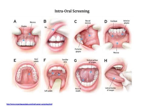 Intra Oral Screening GHC