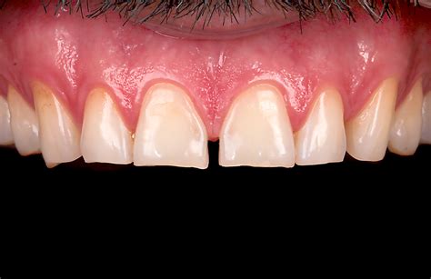 Restauração estética e funcional facetas em resina composta