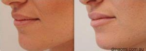 Nasolabial Fold Filler Expert Doctors Injecting At Our Sydney Clinic