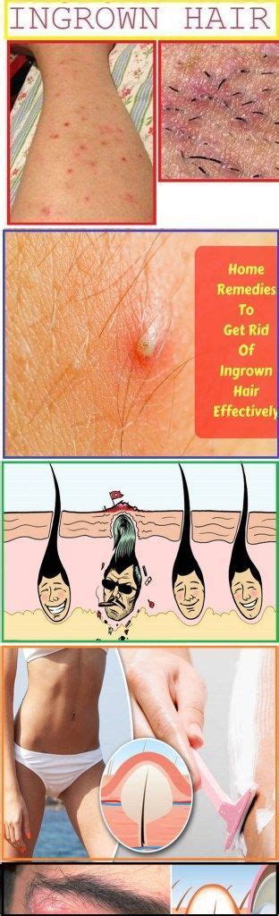 Ingrown Hair Bump On Vag Treatment Jewell Mahoney