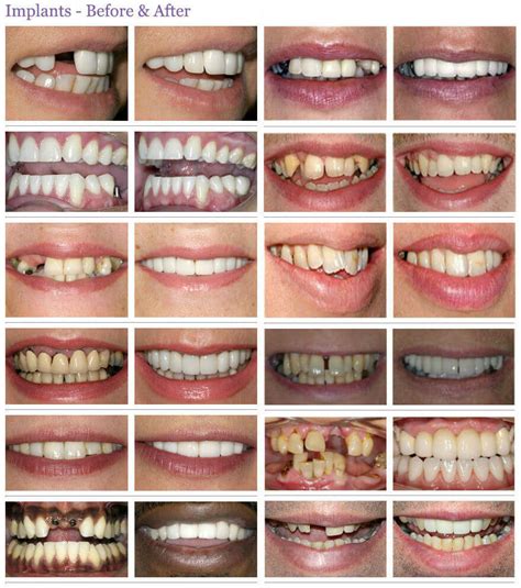 Impressive Gallery Of Implant Patients The Perfect Smile