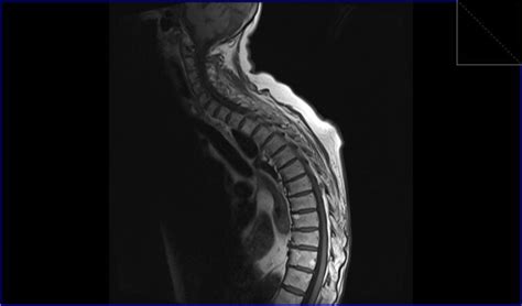 Spinal Schwannoma Mri Radiology Article On Spinal Schwannoma