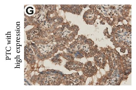 Immunohistochemical staining for HIF 2α TWIST and CXCR4 Columns