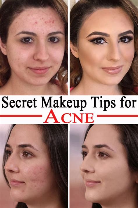How To Cover Up A Pimple Scab Myung Cordova