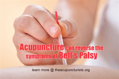 Acupuncture And Bell S Palsy Coral Springs Coconut Creek