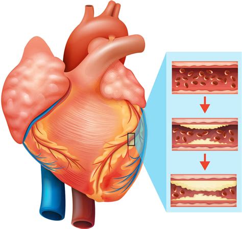 BLOG CENTRO HEART Reevaluación de la cardiopatía isquémica