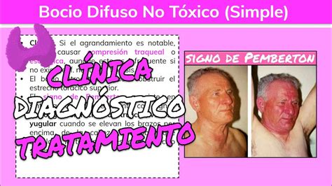 BOCIO DIFUSO NO TÓXICO o BOCIO SIMPLE Síntomas Díagnostico y