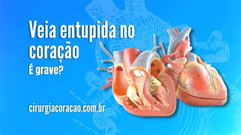 Veia do coração entupida é grave causas sintomas e tratamentos