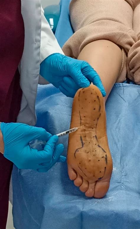 Hiperhidrosis en los pies Exceso de sudoración en los pies en Bogotá