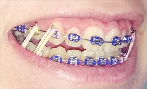 Gomas para los brackets Por qué se usan los elásticos Artículos