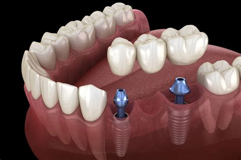 Dental Bridge Vs Implant Pros And Cons And How To Choose Somerset