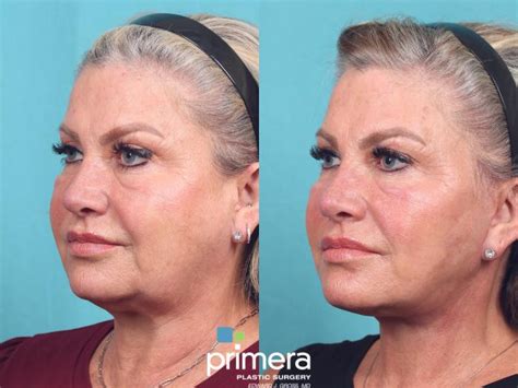 Laser Skin Resurfacing Dot Co Before And After Pictures Case