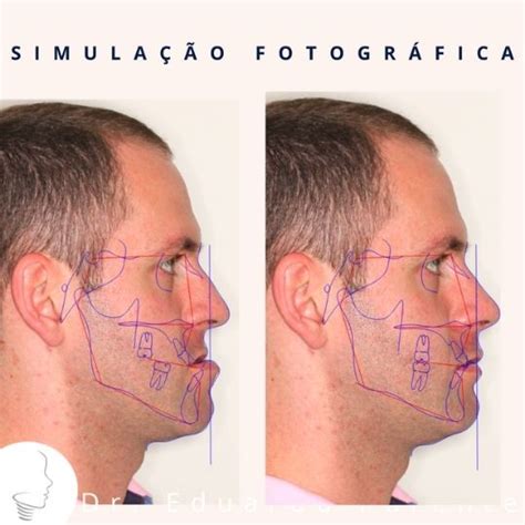 Cirurgia Ortogn Tica Dr Eduardo Parente