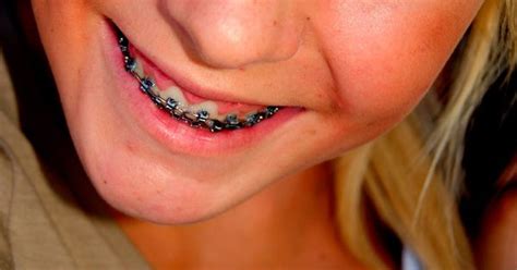 Blue Eyed Blonde With Braces Girls With Braces D Pinterest
