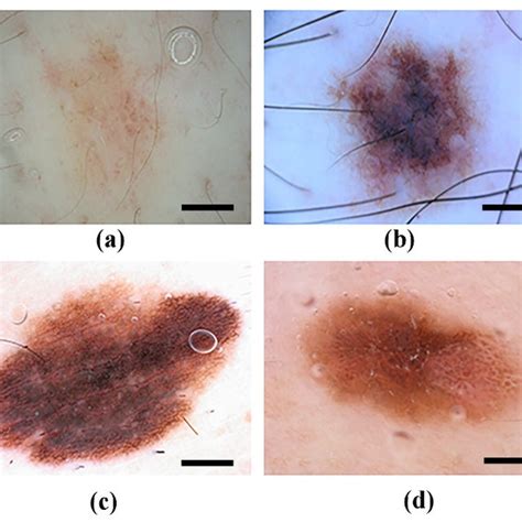 pdf skin lesion segmentation method for dermoscopy images using artificial bee colony algorithm
