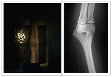 Guía multimedia en procesos de radiología RADIOGRAFIA DE CODO EN