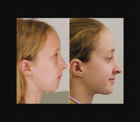 Before And After Of Braces Effect On Face Shape