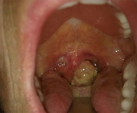 Early Throat Cancer Treatment