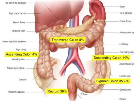 Carcinoma Colon And Management Sigmoid Colon Colon Chronic Migraines
