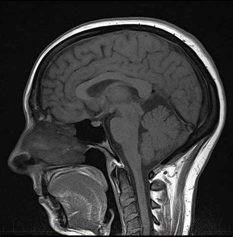 Anatomy Of The Brain Mri Mri Brain Anatomy Mri The Best Porn Website