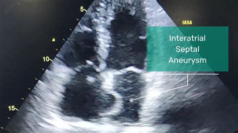 Atrial Septal Aneurysm L Echo Of Atrial Septal Aneurysm YouTube