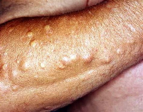 Gardner S Syndrome Symptoms Pictures Causes Treatment