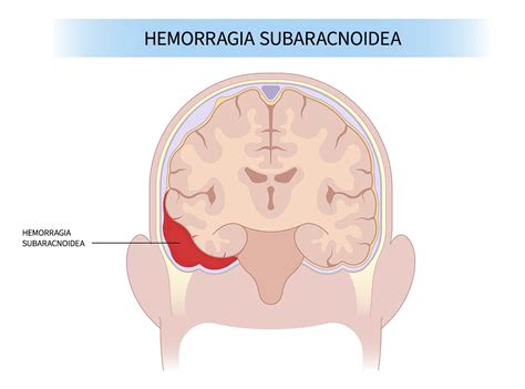 Hemorragia Subaracnoidea Advocate Health Care