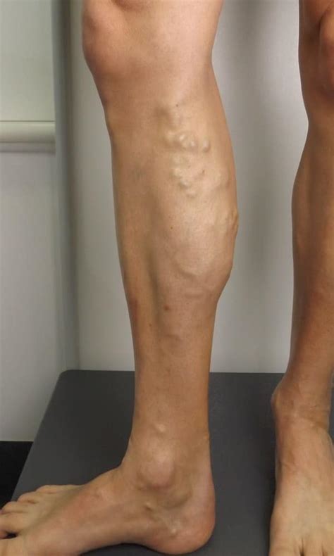 Ugly Leg Veins Treatments Causes Vein Clinic Perth