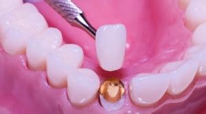 Diferencias Entre Las Coronas De Zirconio Y De 100 Porcelana Estudi
