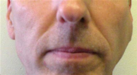Parotid Gland Swelling