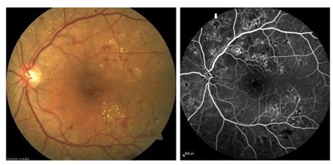 on detection of diabetic retinopathy via multiple instance learning